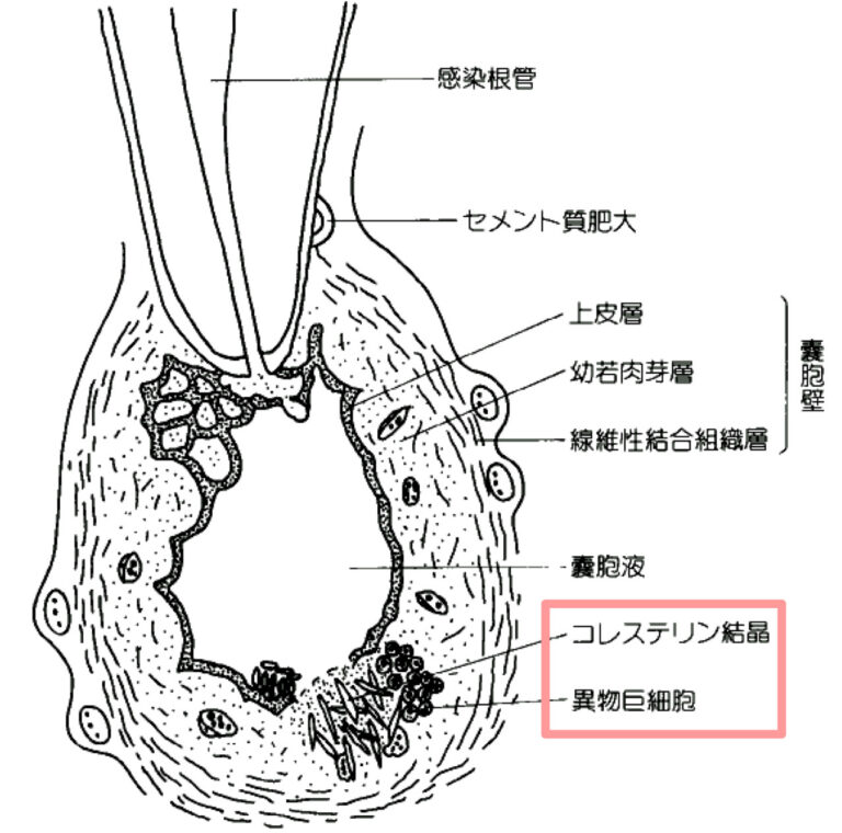 歯原性嚢胞について知っておこう! | 医療法人赤坂会